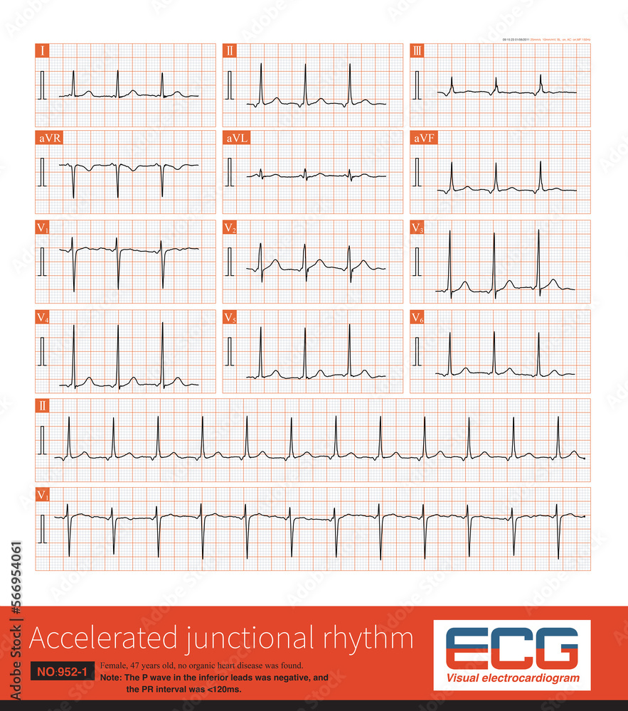 Photo & Art Print The retrograde P wave of the inferior leads can come ...