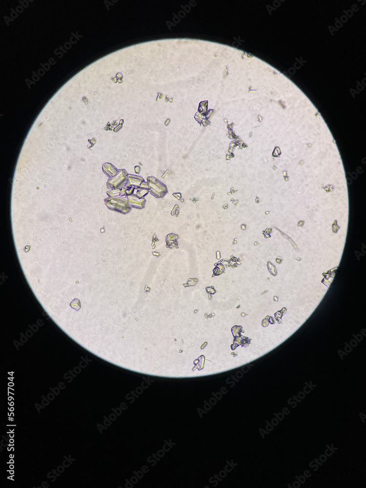 Foto de Microscopic view of struvite crystals from urinary sediment ...