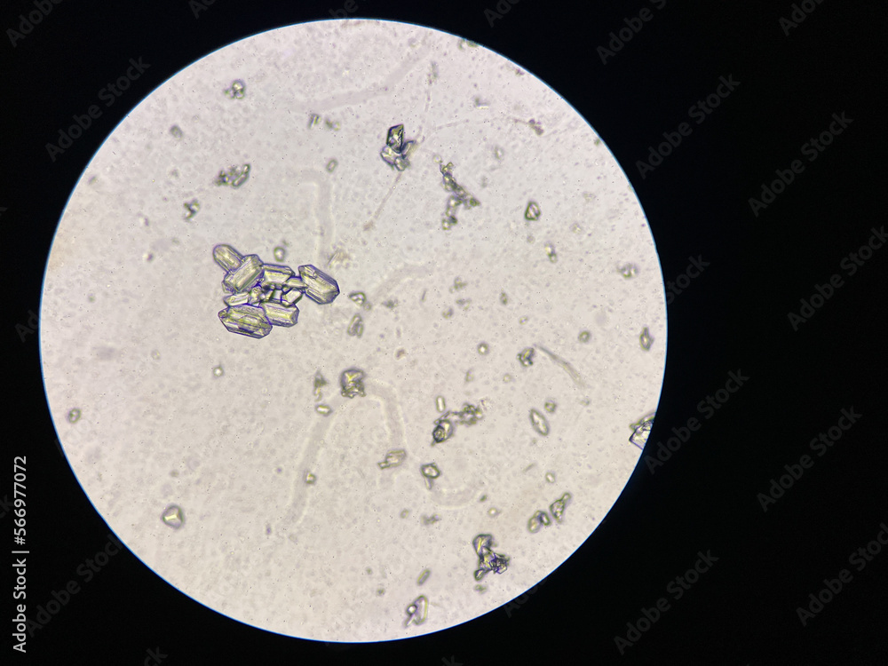 Microscopic view of struvite crystals from urinary sediment. Magnesium ...