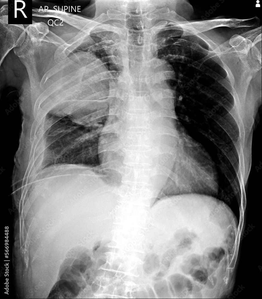 pneumothorax on ICD. chest x ray AP supine Stock Photo | Adobe Stock