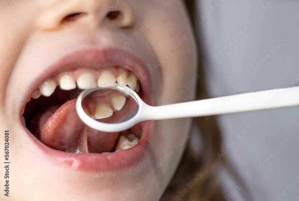 doctor dentist checking little girl teeth with dental inspection mirror ...