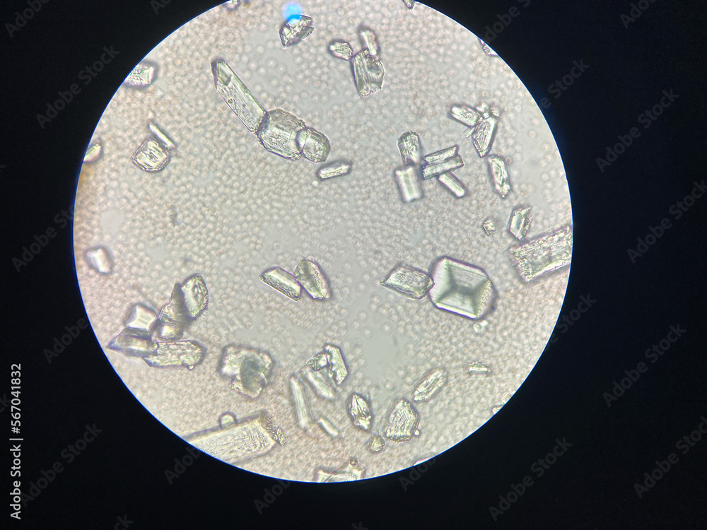Urine Sediment Exam Struvite Crystals With Pus Cells And