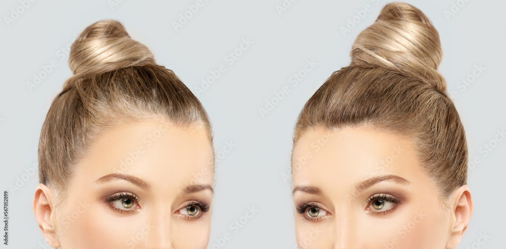 Alopecia Areata,female pattern baldness,Treatment for hair loss,Hair ...