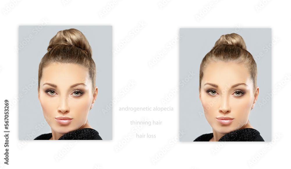 Alopecia Areata,female pattern baldness,Treatment for hair loss,Hair ...