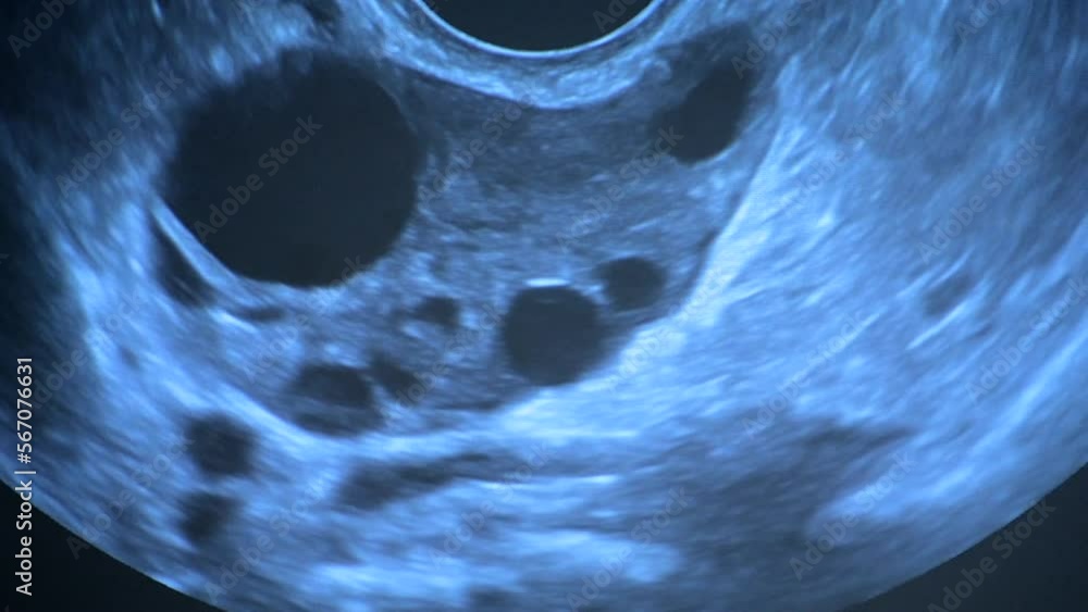 Utrasound image on the monitor close-up. Ultrasound Scan display ...