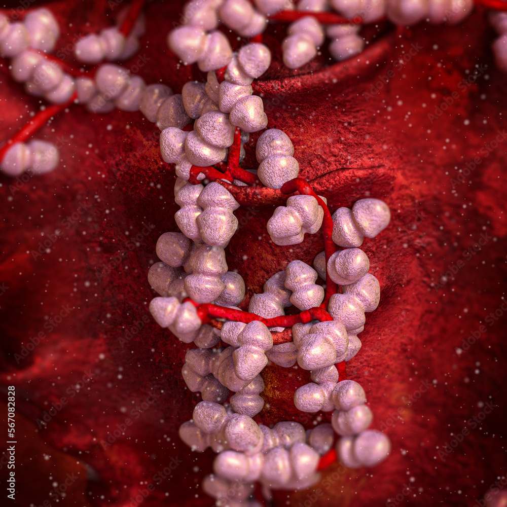 Medical background, Staphylococcus aureus, a type of spherical gram ...