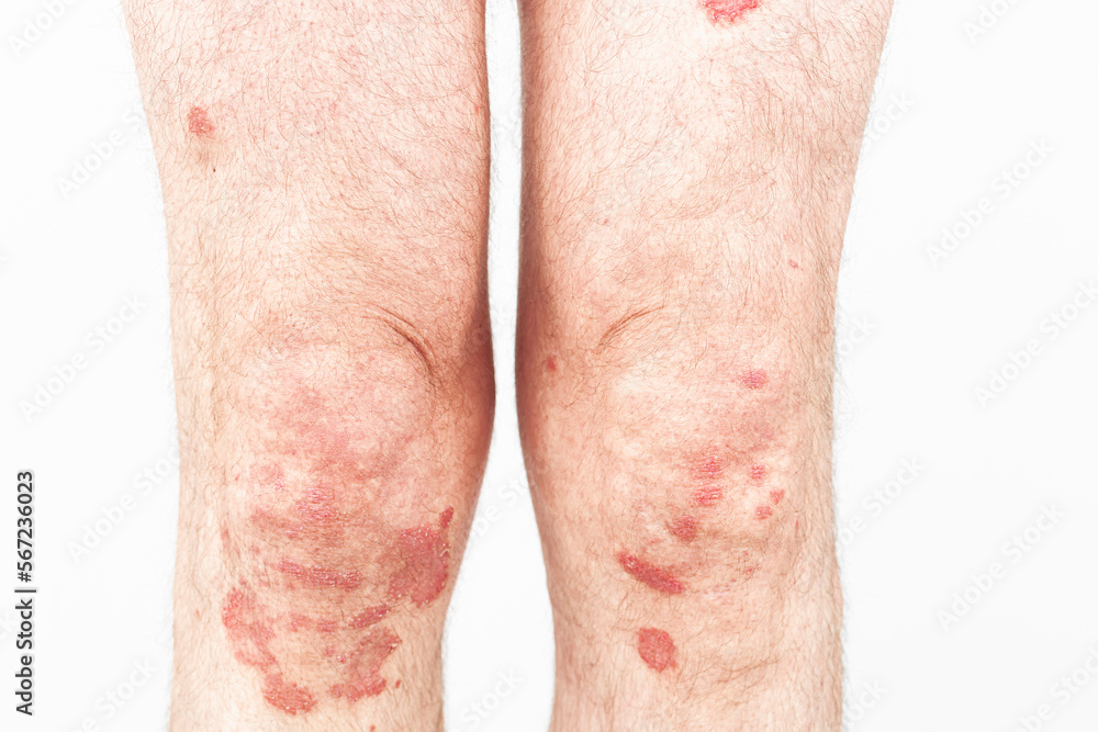 Eczema on legs. Allergy spots and red skin inflammation on feet. Close ...