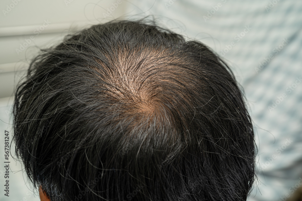 Bald in the middle head and begin no loss hair glabrous of mature Asian ...