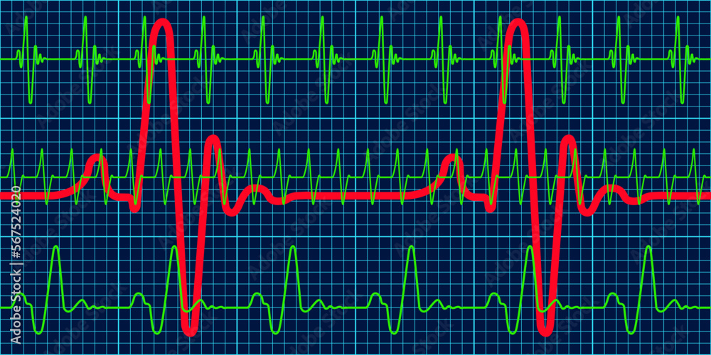 Cardiogram charts pattern Stock Vector | Adobe Stock