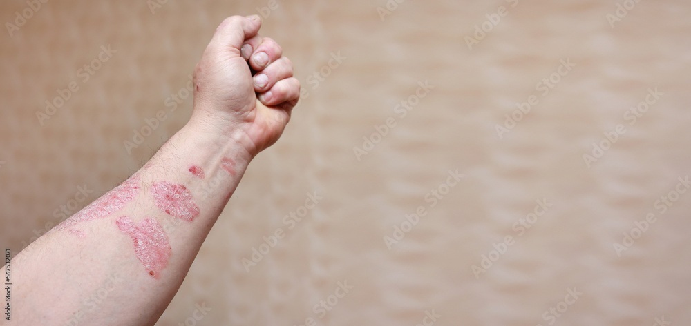 Man with sick arm, dry flaky skin on his hand with vulgar psoriasis ...