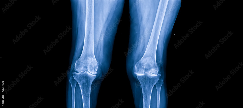 Foto Stock Plain radiograph on dark background in hospital.The xray use ...