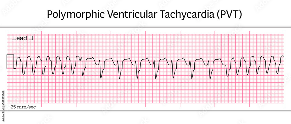 Polymorphic Ventricular Tachycardia (PVT) ECG – Polymorphic VT - 8 ...