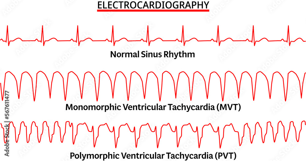 Set of ECG Common Abnormalities - Normal Sinus Rhythm - Monomorphic VT ...
