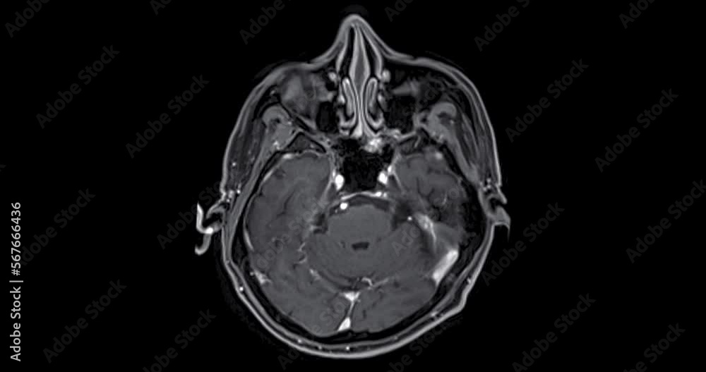 MRI Brain axial view with gadolinium can help doctors look for ...