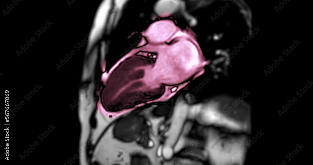 MRI heart or Cardiac MRI ( magnetic resonance imaging ) of heart in ...