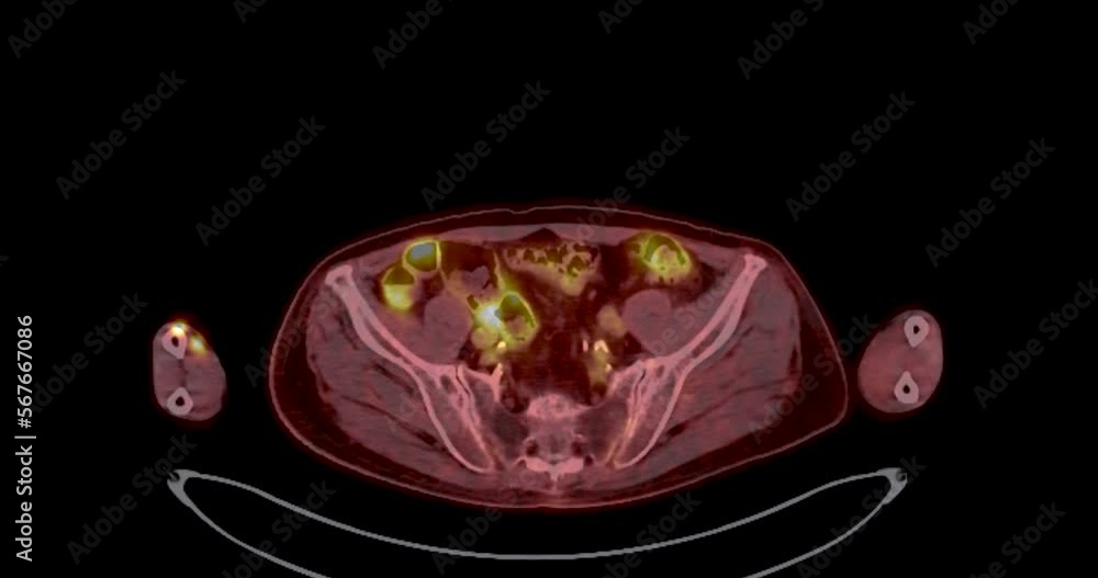 PET CT SCAN ( Positron Emission Tomography ) of whole human body 3d ...