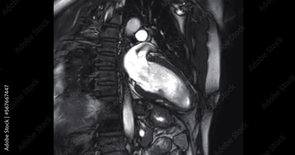 MRI heart or Cardiac MRI ( magnetic resonance imaging ) of heart in ...