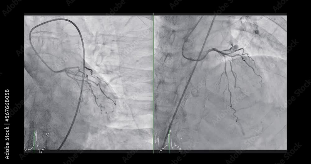 Cardiac catheterization showing coronary arteries for diagnosis cardiac ...