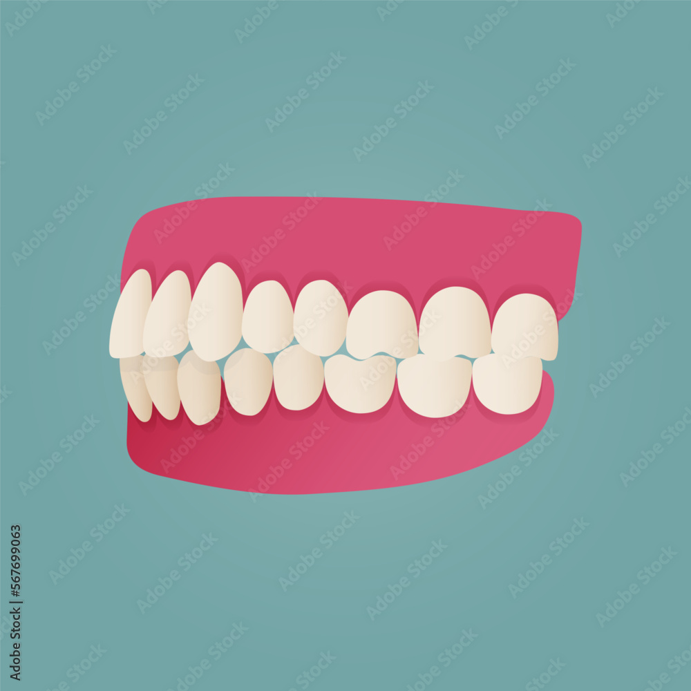 Human teeth malocclusion set with realistic images of mouth jaws with ...