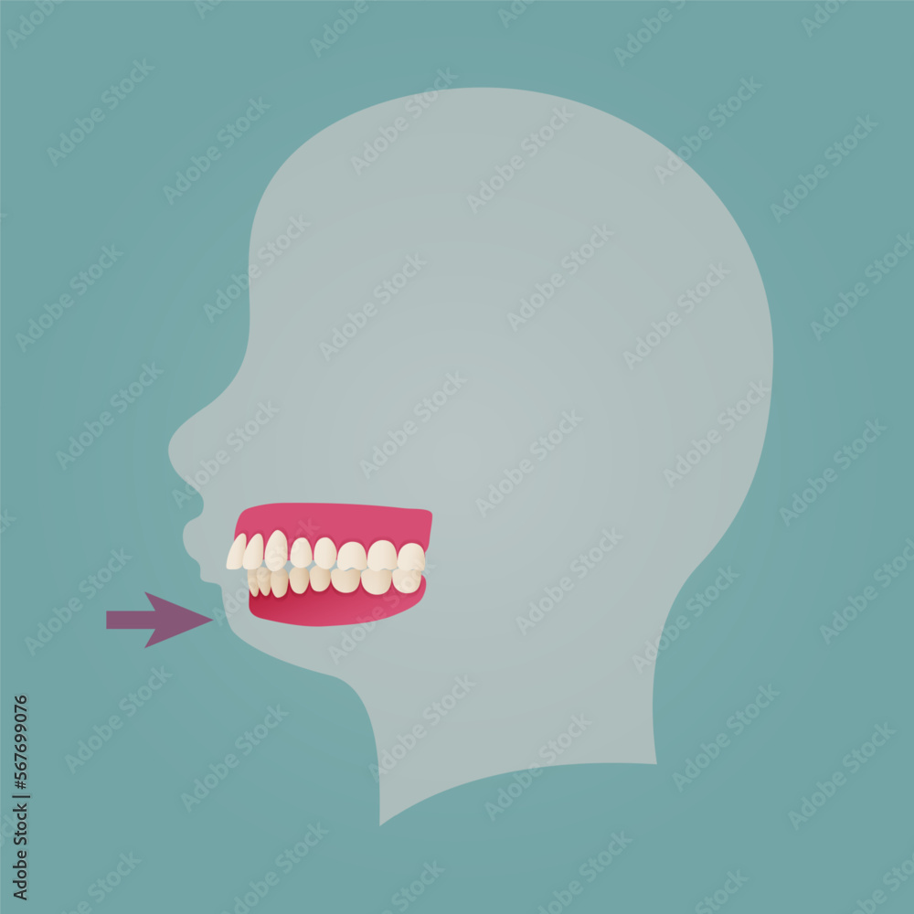 Human teeth malocclusion set with realistic images of mouth jaws with ...