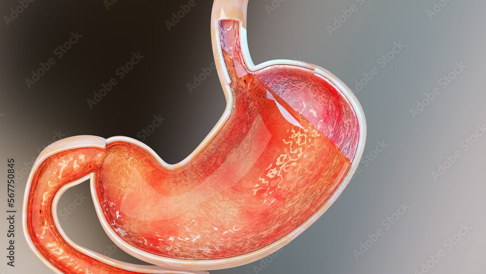 Stomach Acid Relux. Esophagus, gerd. Pain In The Digestive System ...