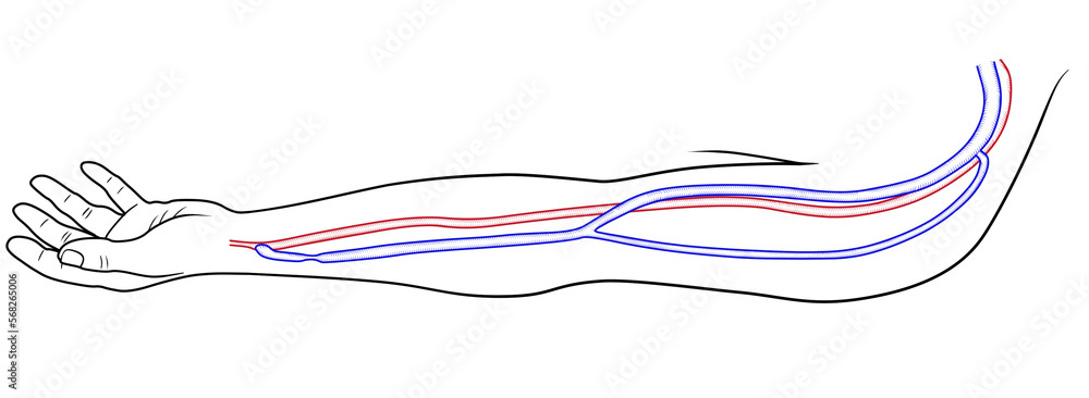 radiocephalic arteriovenous fistula stenosis at the anastomosis Stock ...