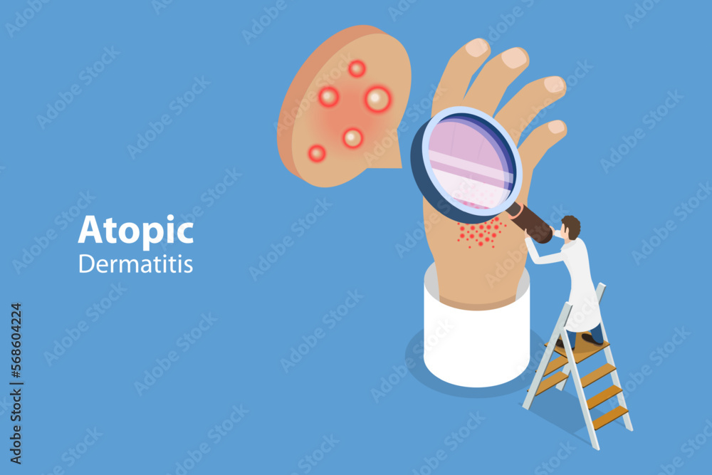 3d Isometric Flat Vector Conceptual Illustration Of Atopic Dermatitis