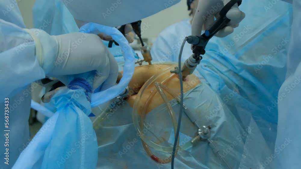 Laparoscopic Tool Of Cholecystectomy Used During Surgery Stock ビデオ