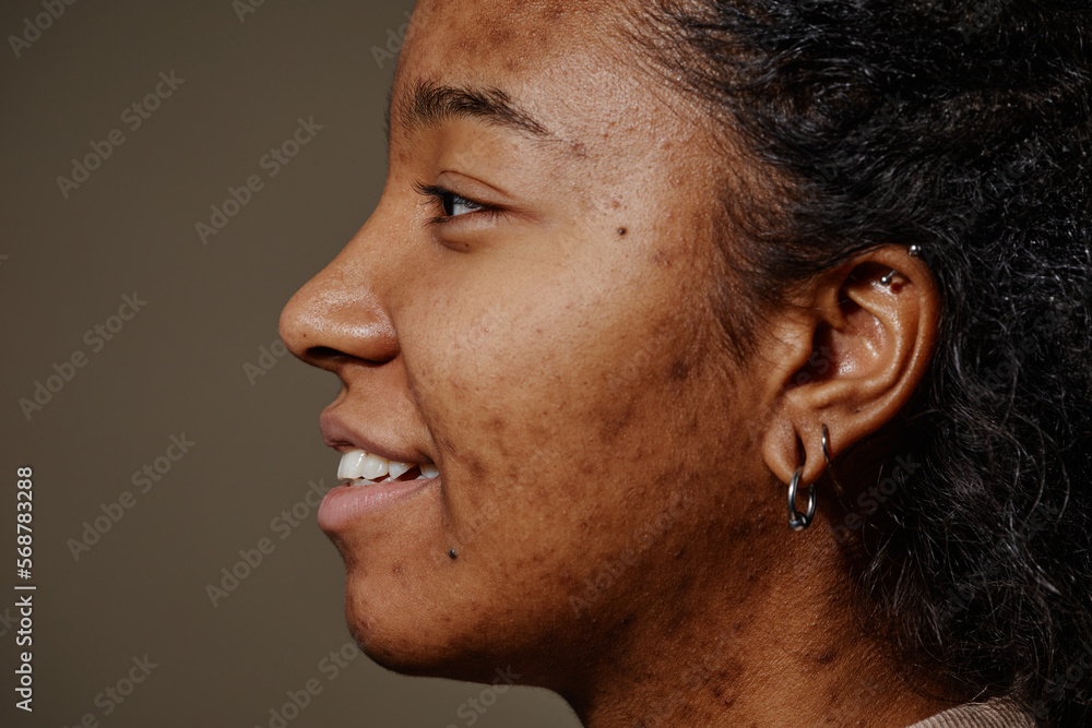 Close up smiling black woman with acne scars on face real skin texture ...