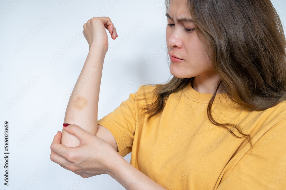 Worried woman having bruise occur on her skin. A bruise is a common ...