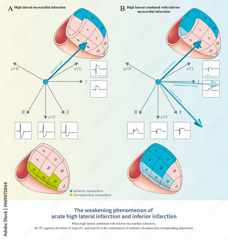 When two opposite myocardium are ischemic at the same time, the ST ...