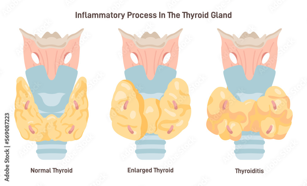 Thyroiditis, thyroid inflammation. Thyroid gland produces abnormal ...