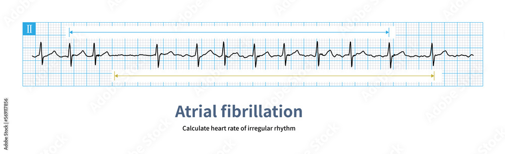 Atrial fibrillation is a kind of atrial tachyarrhythmia, and the ...