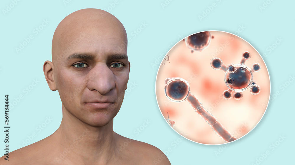 Ilustracja Stock: Rhinofacial conidiobolomycosis in a man and ...