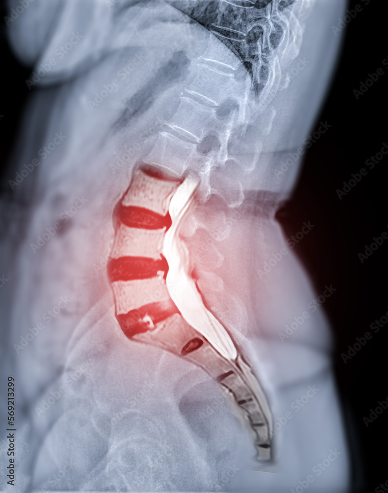 X-ray image of lumbar Spine or L-s spine lateral view with MRI l-s ...