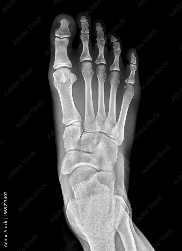Foot x-ray image AP view isolated on black background. Stock Photo ...