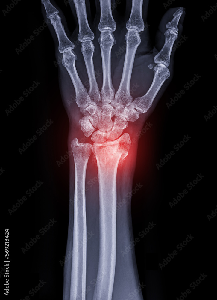 Film x-ray Wrist joint showing fracture of ulnar bone isolated on black ...