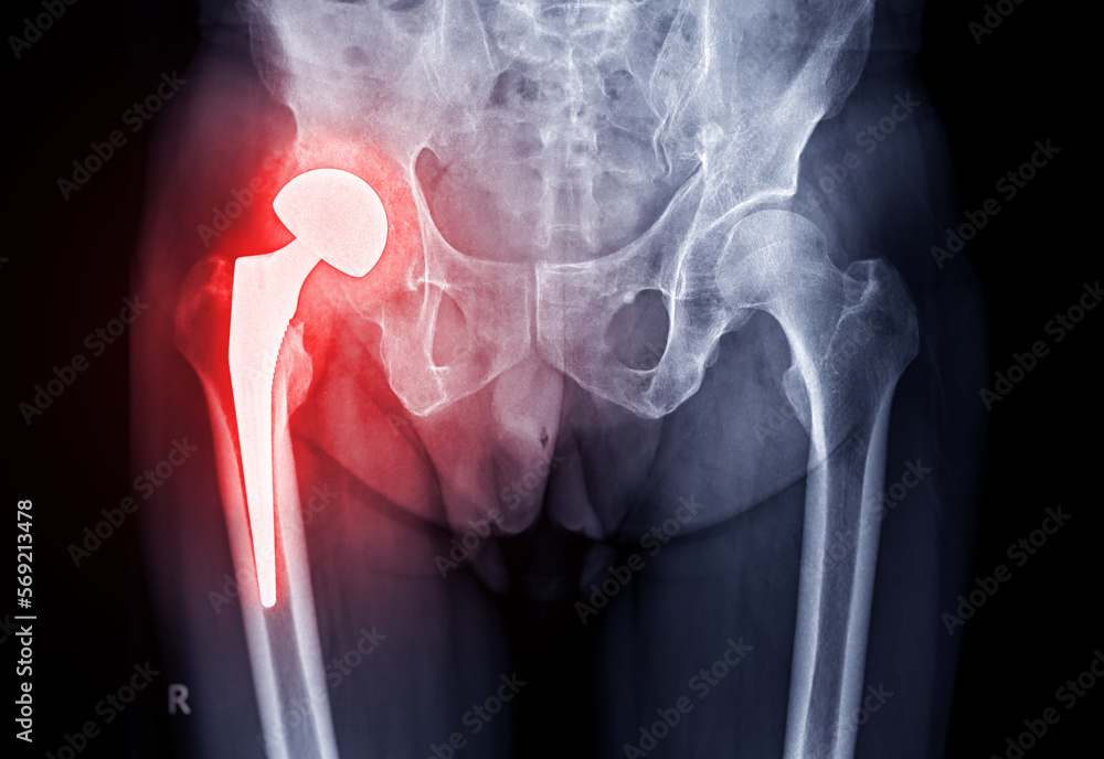 Titanium Joint Replacement