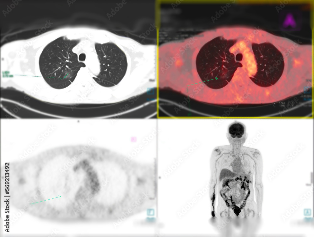 Positron emission tomography (PET) CT scan uses a radioactive drug ...