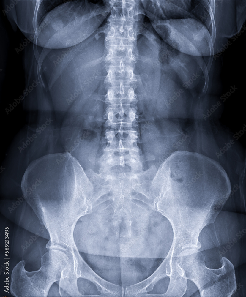 X-ray image of lumbar Spine or L-s spine front view for diagnosis lower ...