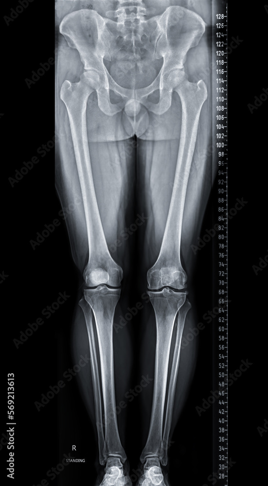 Scanogram is a Full-length standing AP radiograph of both lower ...