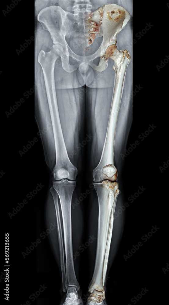 Scanogram is a Full-length standing AP radiograph of both lower extremities including the hip ...