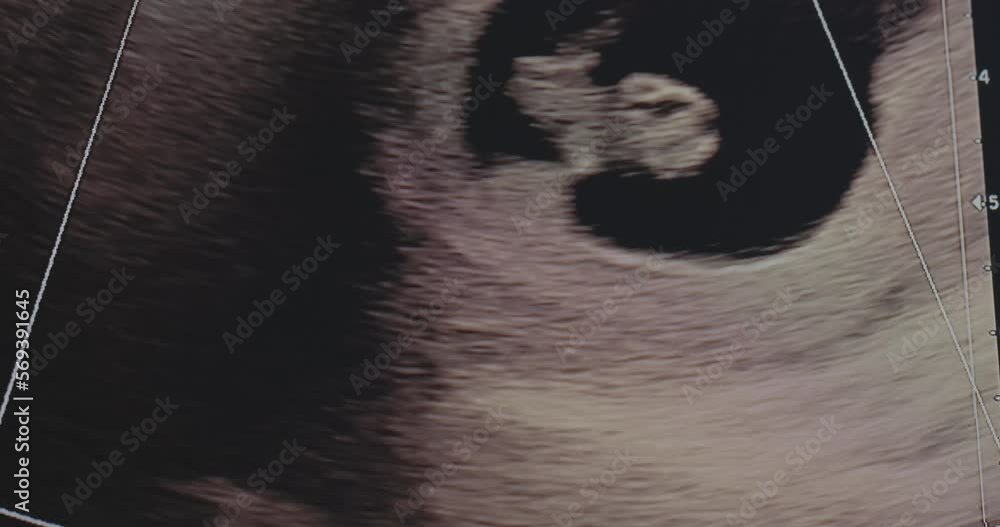 Ultrasound of an 8-week-old fetus in a mother's womb, showing colorized ...