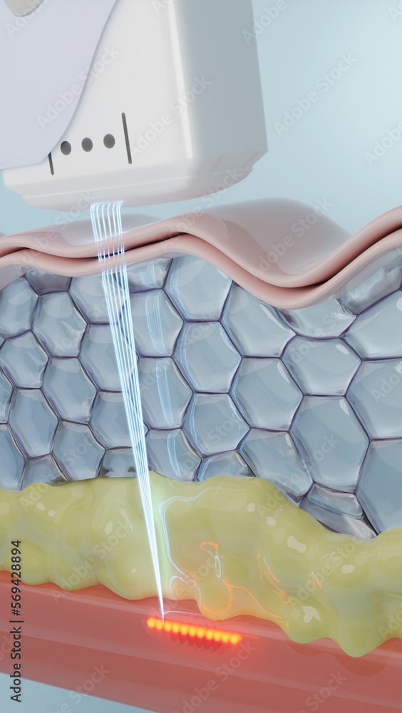 Ulthera laser treatment shot to SMAS skin. 3D rendering. Stock ...