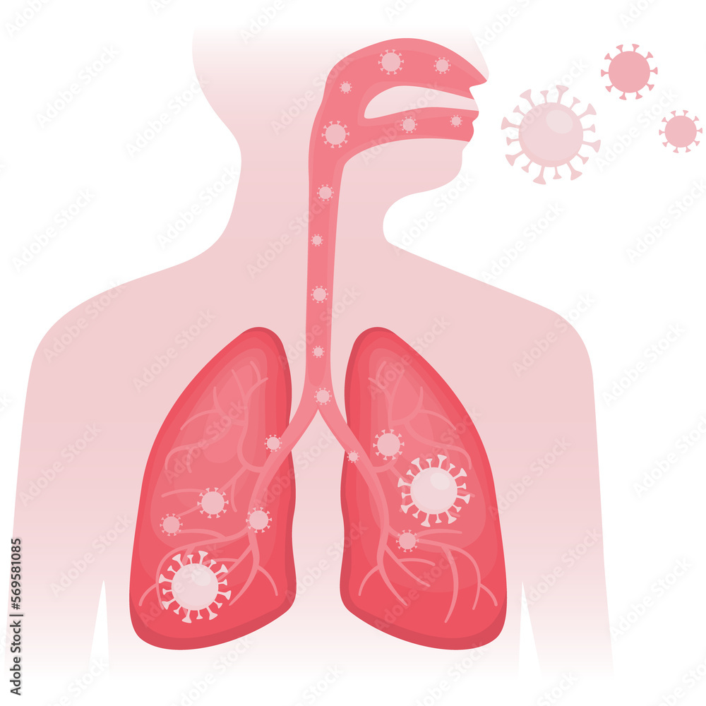 Flat vector illustration of infected human lungs with viral pneumonia ...