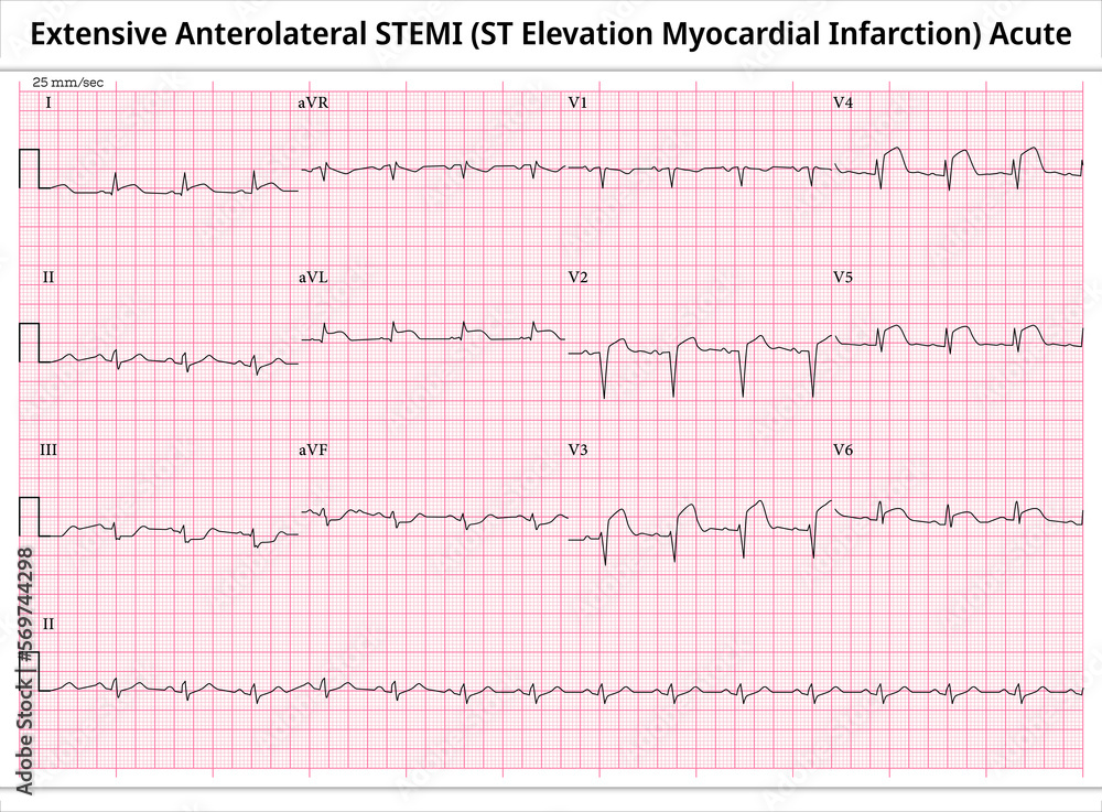 Extensive Anterolateral STEMI (ST-Elevation Myocardial Infarction ...