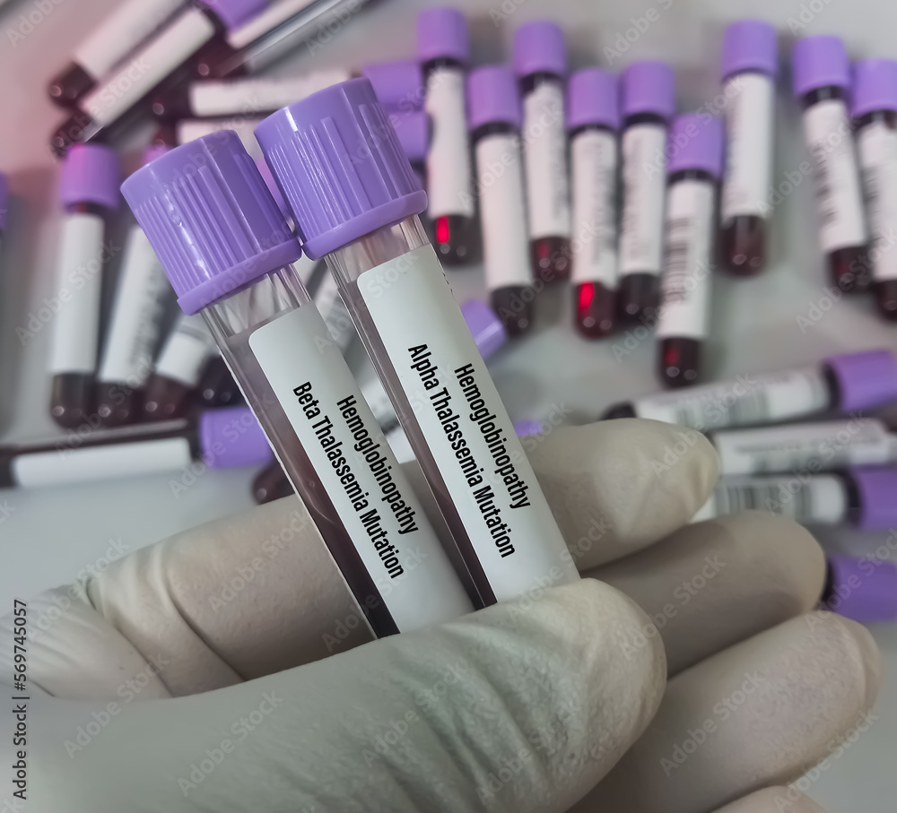 Hemoglobinopathy (Alpha and beta thalassemia mutation) test ...