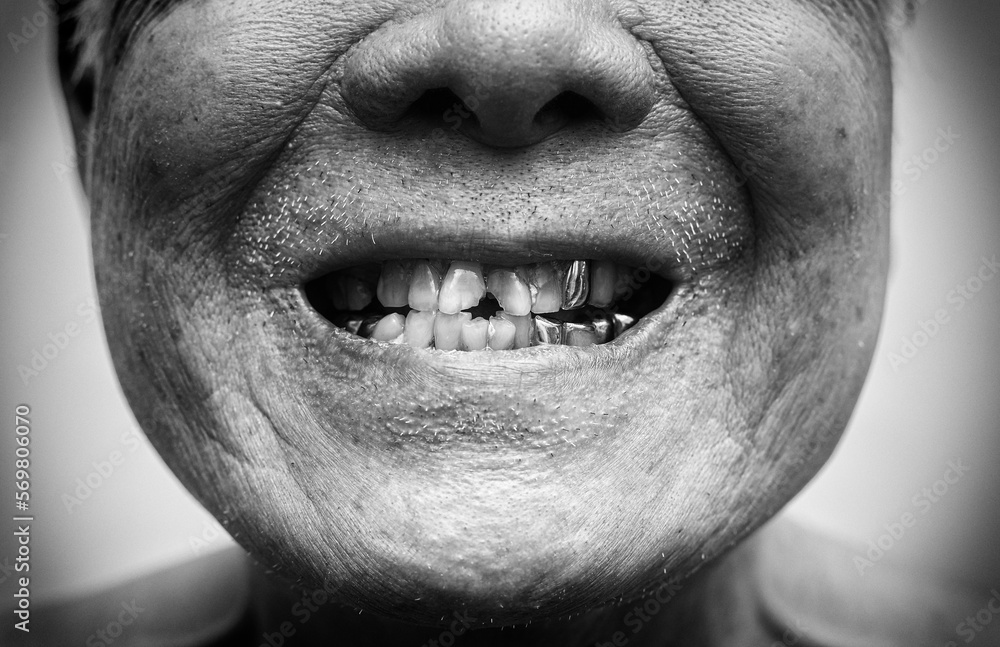 The unhealthy teeth of an Asian elder cracked from old age. Metal teeth ...