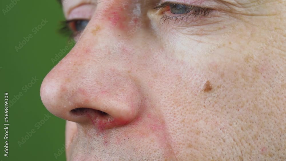 A mans face in close-up with dermatitis. Red irritated skin. The ...