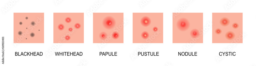 Stages of development of acne. Inflamed skin with scars, acne and ...